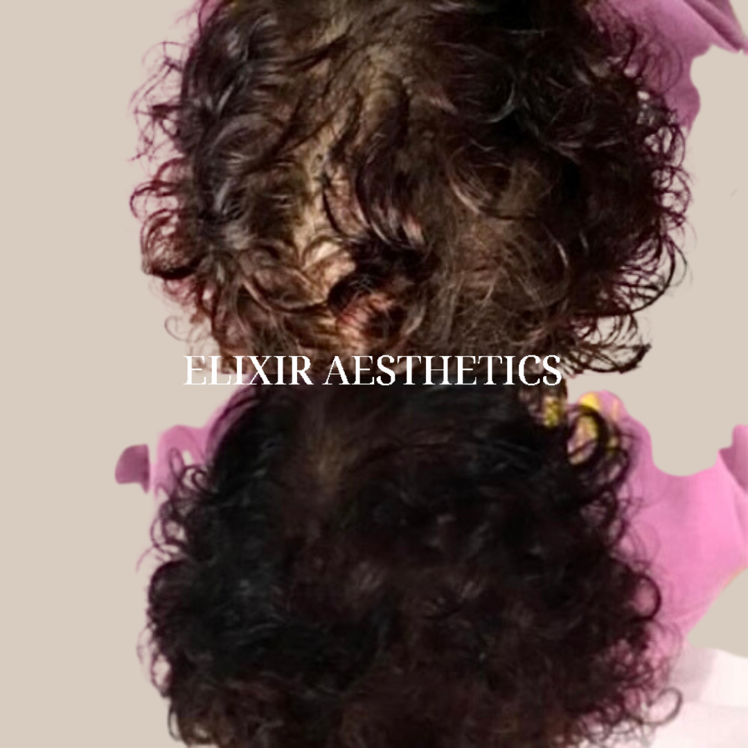 BENEV Hair Restoration – Elixir Aesthetics Spa